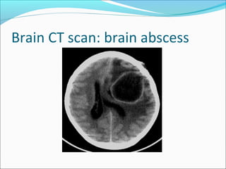 Chs 3111 cns pathology radiology | PPT