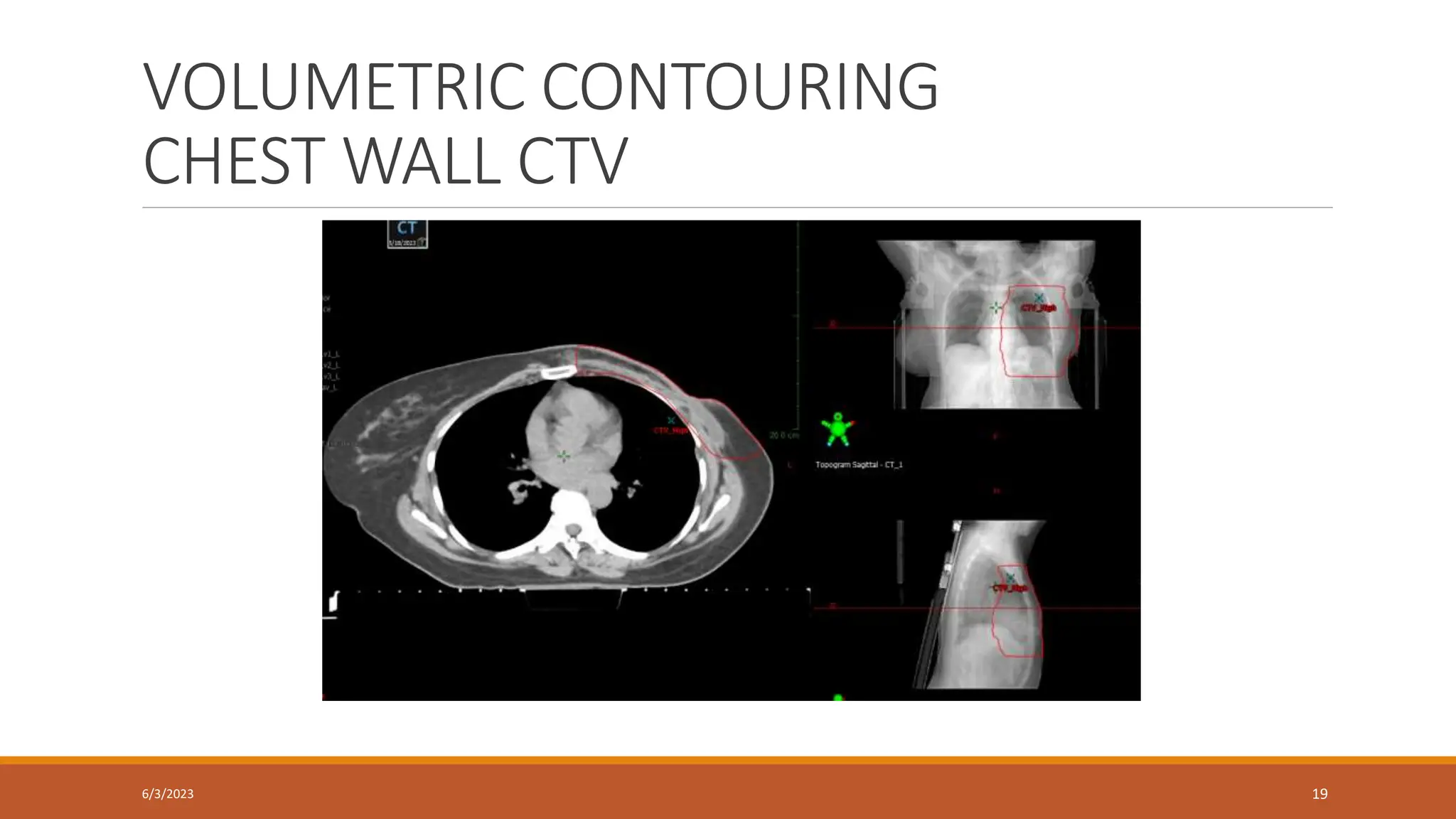 a brief overview about management of ca breast.pptx