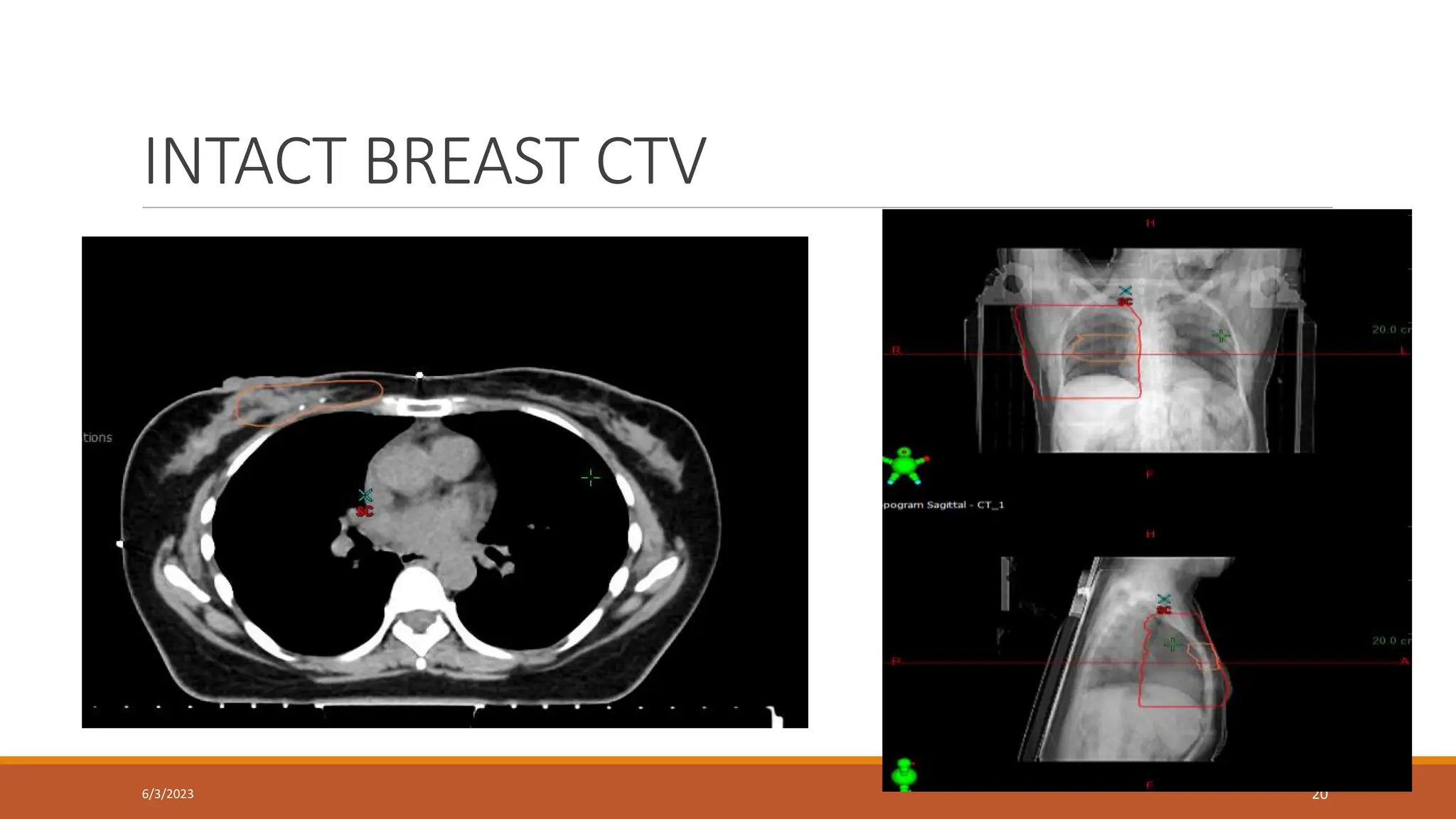 a brief overview about management of ca breast.pptx