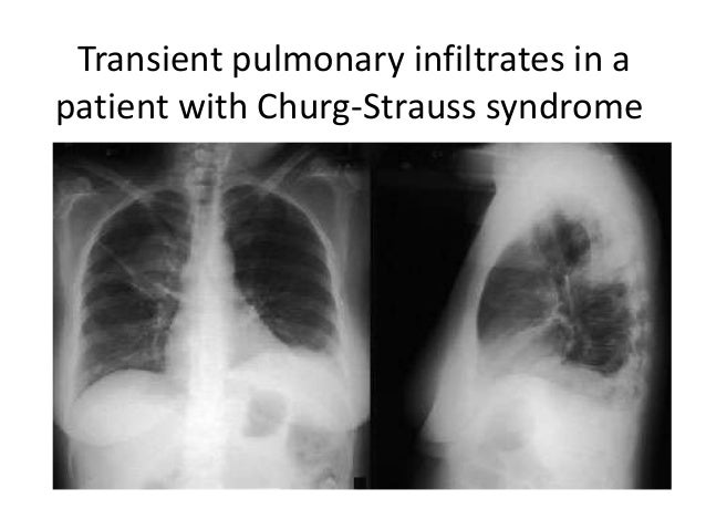 Churg strauss syndrome
