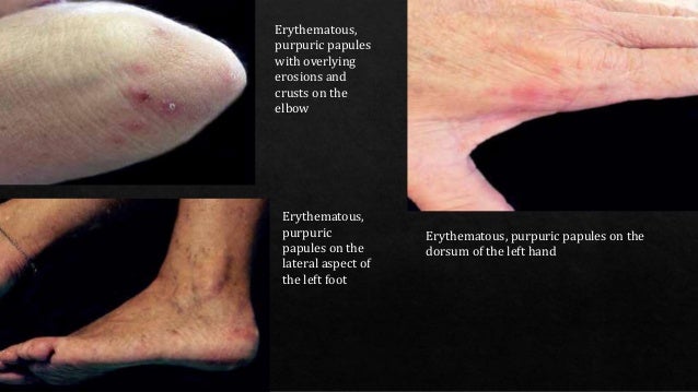 Churg strauss syndrome