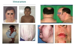 Chusing syndrome echi.pptx