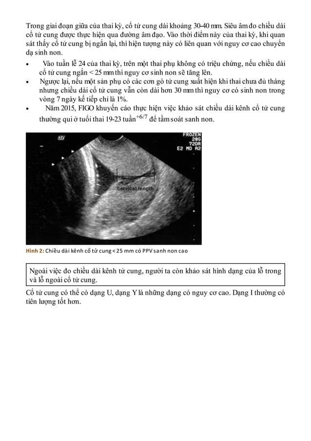 CHUYỂN DẠ SINH NON | PDF