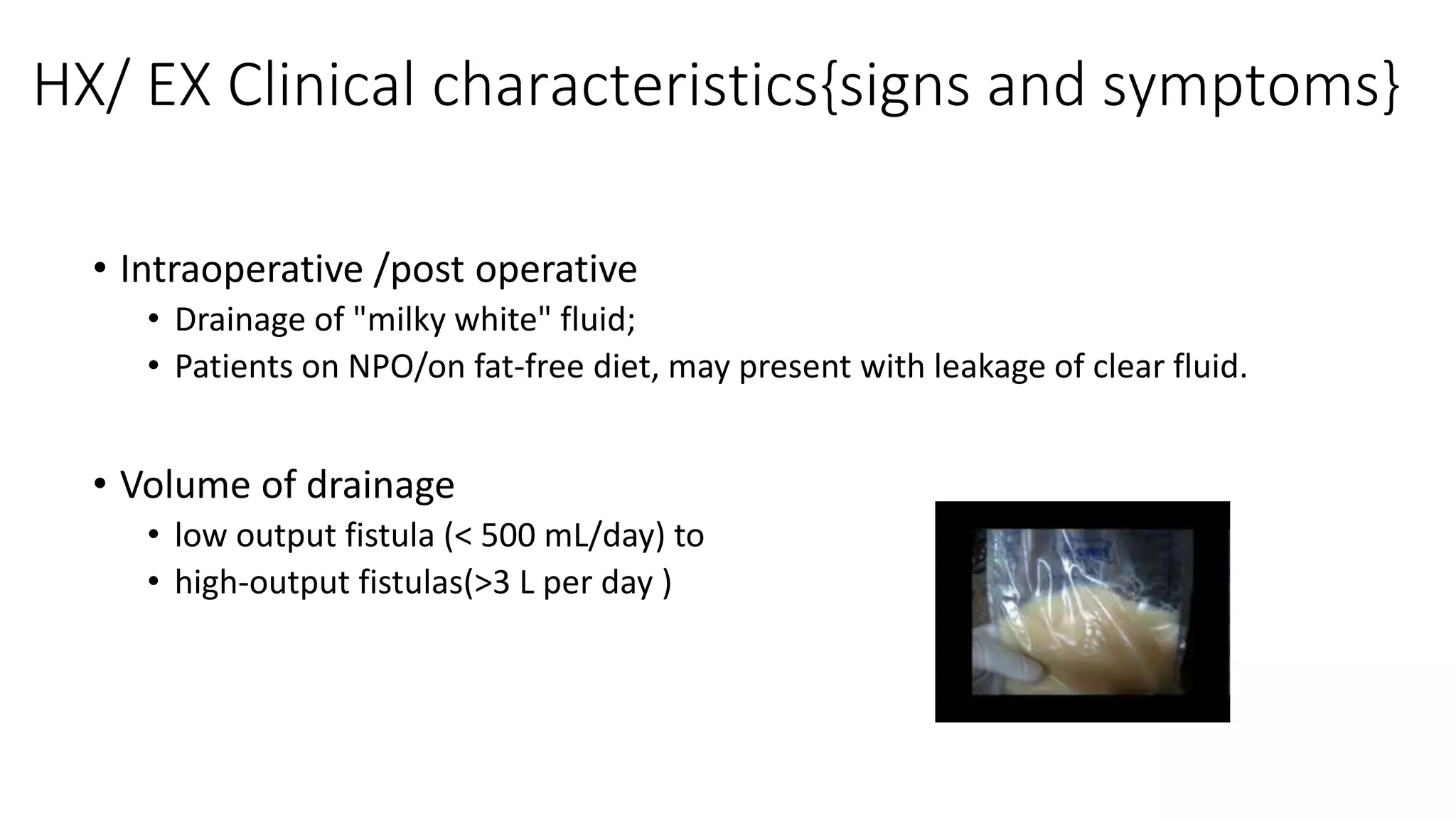 Chyle leakage | PPTX