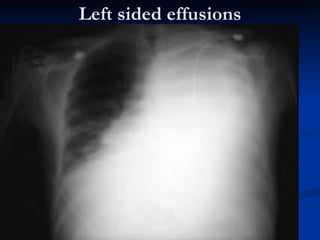 Chylothorax | PPT