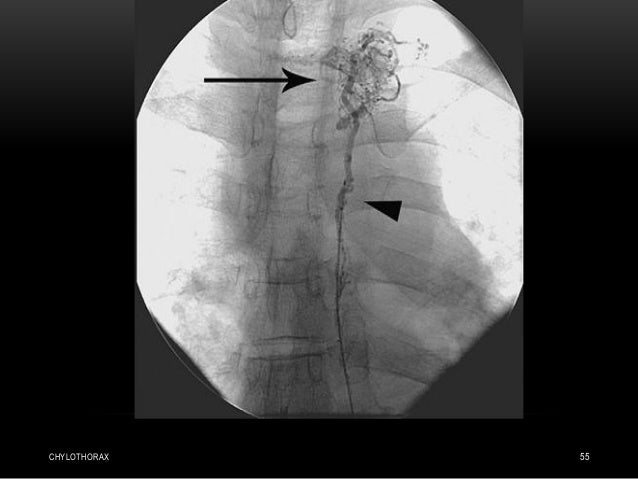 Chylothorax and chyloptysis