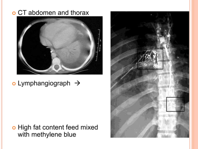 Chylothorax | PPTX | Lung and Respiratory Health | Diseases and Conditions