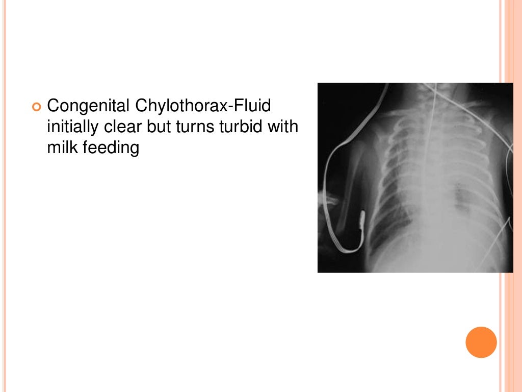 Chylothorax