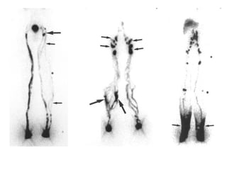 Chylous Ascites | PPT