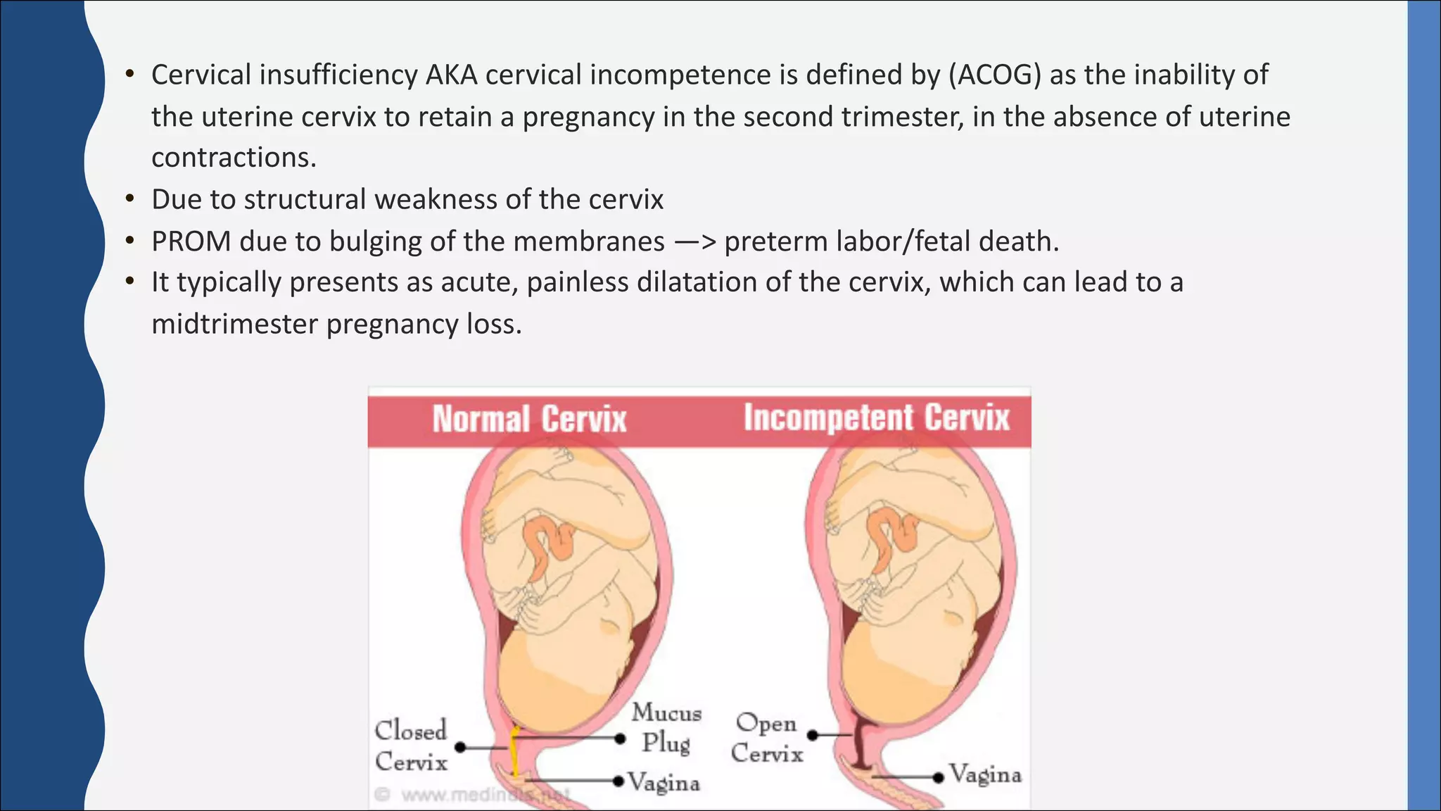 Cervical Incompetence (insufficiency) | PDF