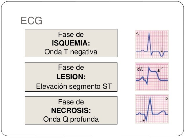 Cardiopatia isquemica