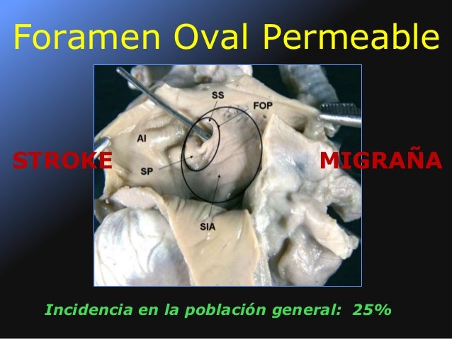 Cia y Foramen oval permeable selección para cierre por cateterismo