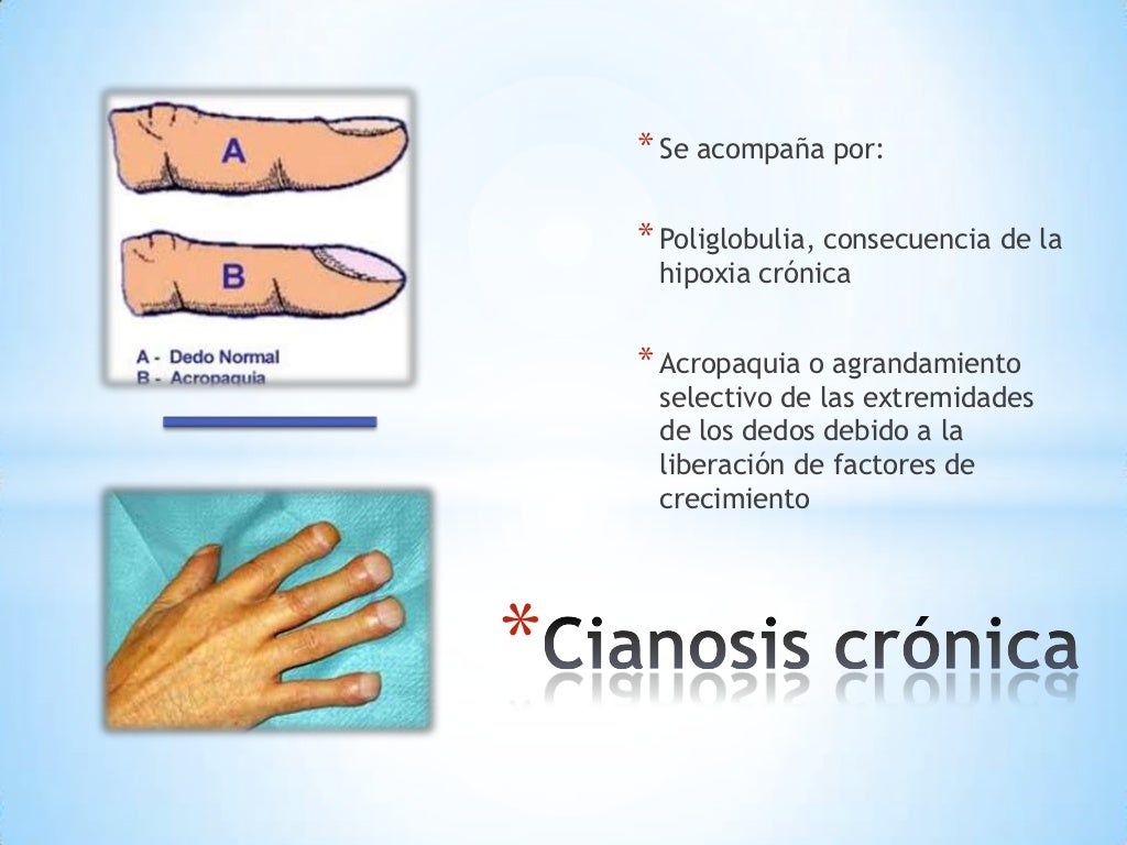 Cianosis