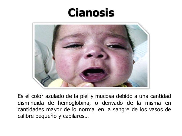 Cianosis