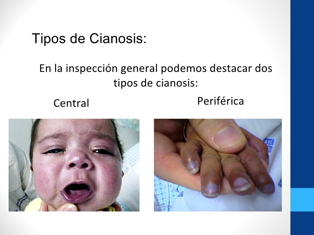 Cianosis