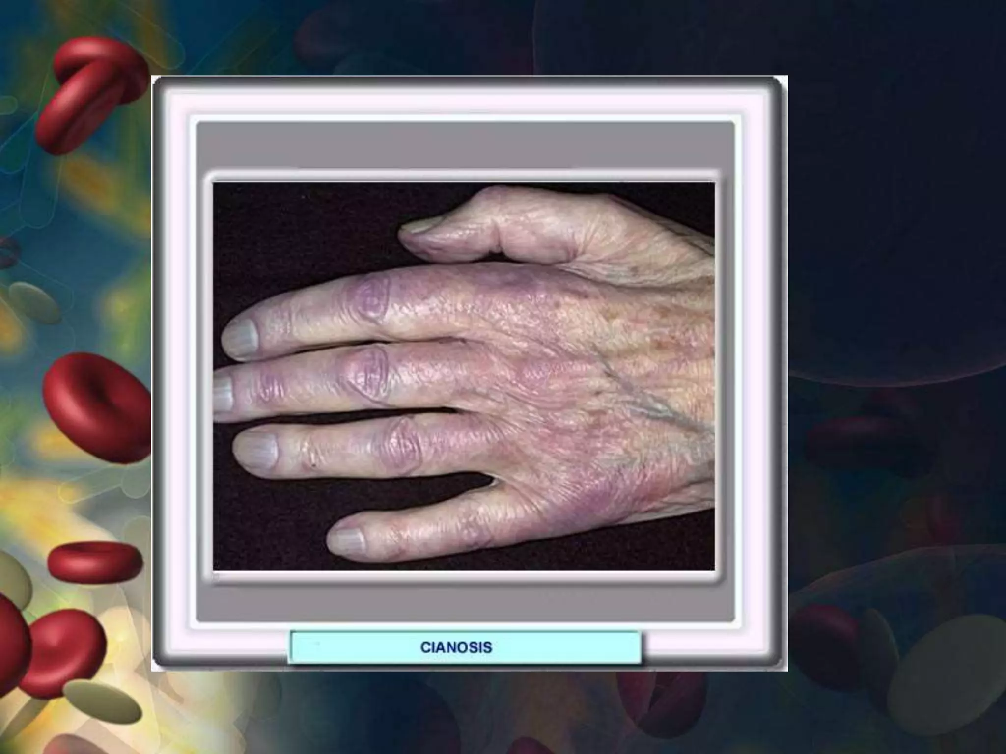 Cianosis Central y Periferica