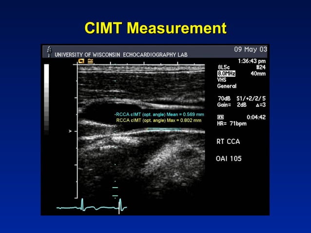 Stein cimt for shape 11-05 | PPT | Heart and Cardiovascular Diseases ...