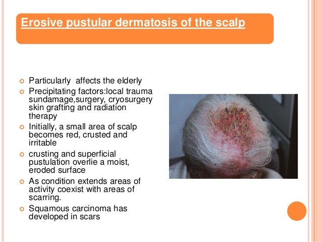 Cicatricisial alopecia
