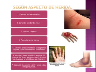 Cicatrización de heridas cirugia. maria asteria. | PPTX