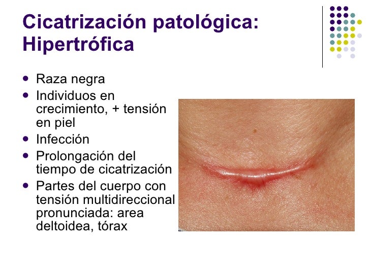 Fisiopatología De La Cicatrización Patológica – KTSC