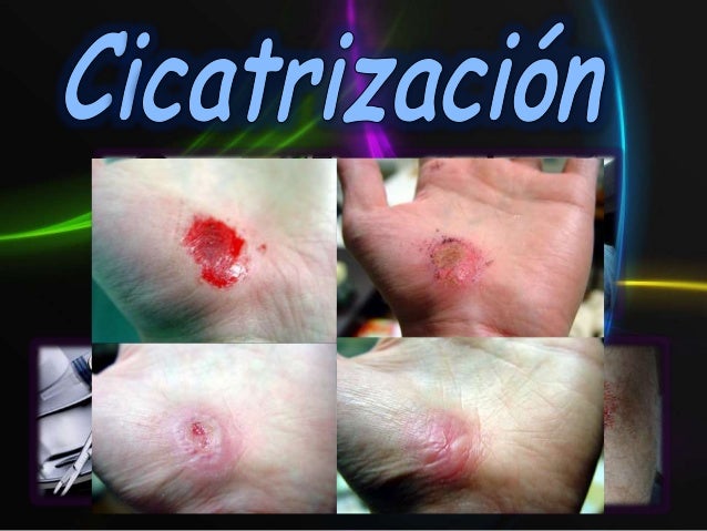 Cicatrizacion DE LAS HERIDAS 2014 a.