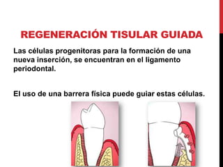 cicatrizacion-y-regeneracion-tisular-guiada-pptx