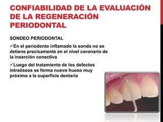 Cicatrizacion y regeneracion tisular guiada | PPTX