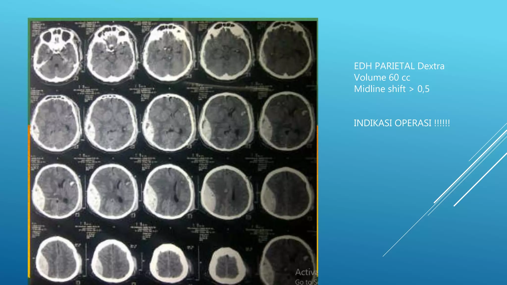 Tatalaksana Cidera kepala otak, COR | PPTX