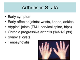 Systemic JIA the Clinical Picture | PPTX | Lung and Respiratory Health ...