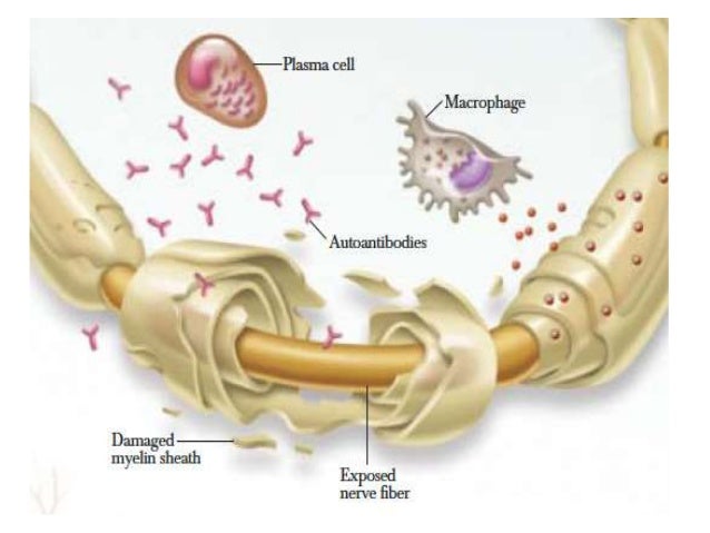 CIDP and NCS protocol