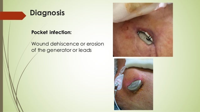 CIED Infections: Incidence, Diagnosis, Microbiology and Prognosis