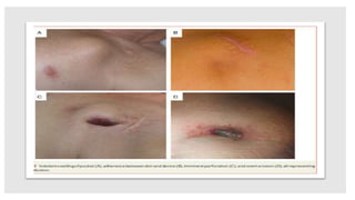 CIED POCKET INFECTION.pptx