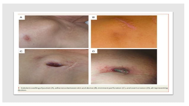 CIED POCKET INFECTION.pptx | Infectious Diseases | Diseases and Conditions