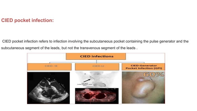CIED POCKET INFECTION.pptx | Infectious Diseases | Diseases and Conditions