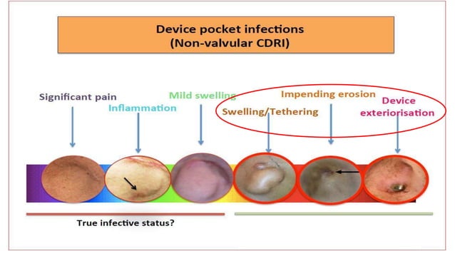 CIED POCKET INFECTION.pptx | Infectious Diseases | Diseases and Conditions
