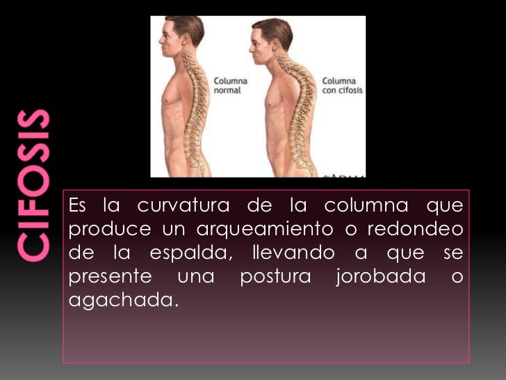 Cifosis