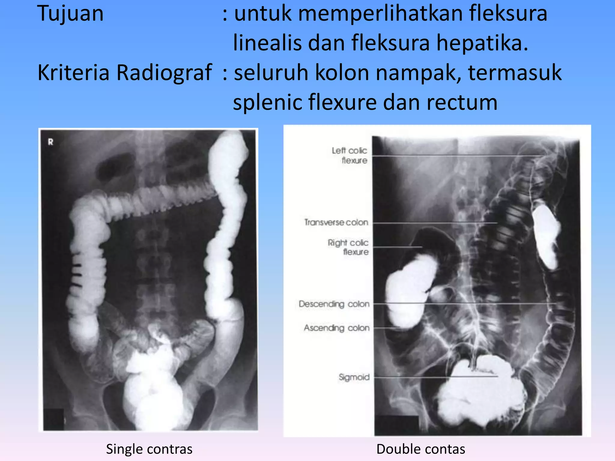 Teknik Pemeriksaan Radiografi Colon In Loop (CIL) | PPTX