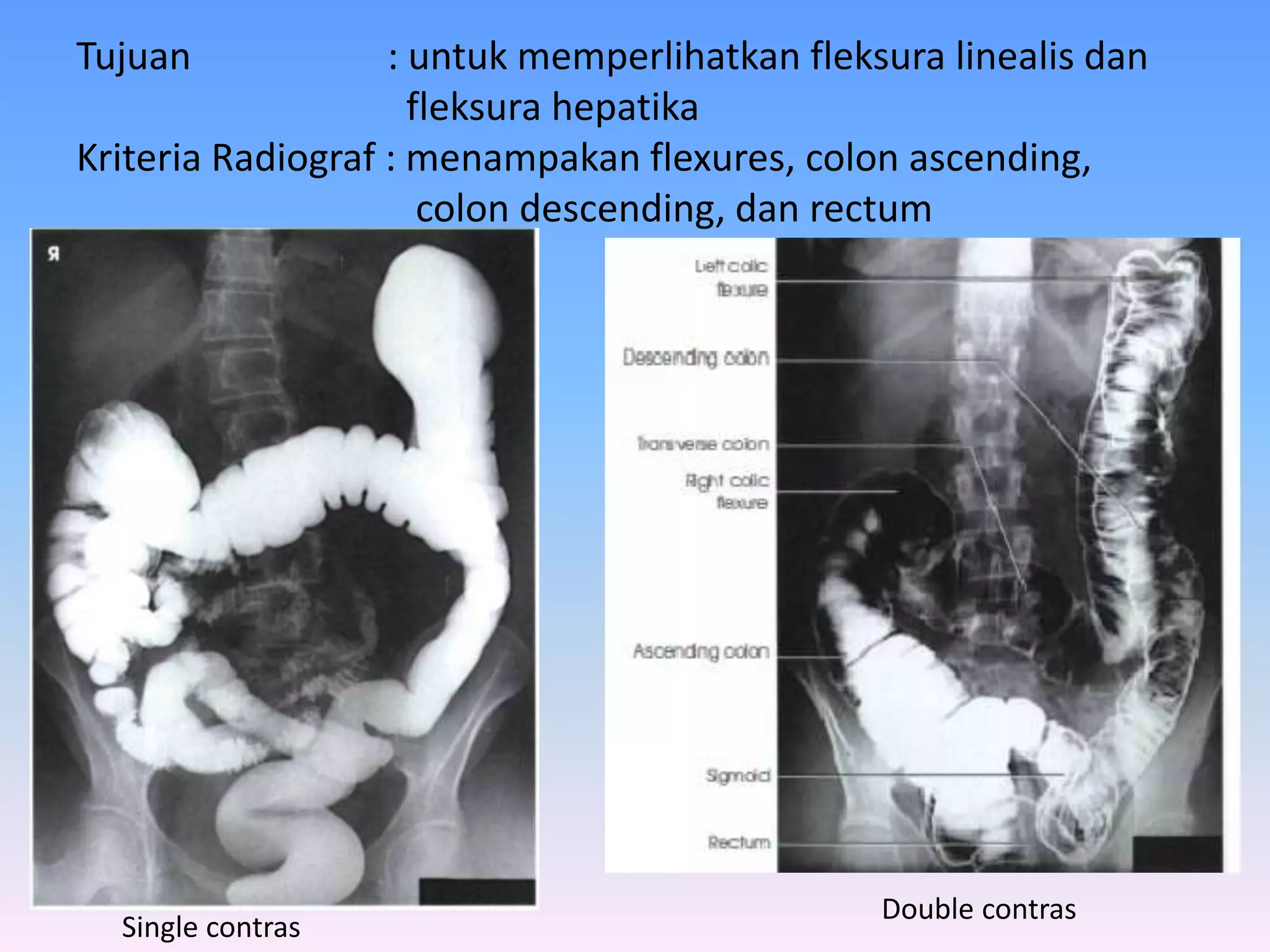 Teknik Pemeriksaan Radiografi Colon In Loop (CIL) | PPTX