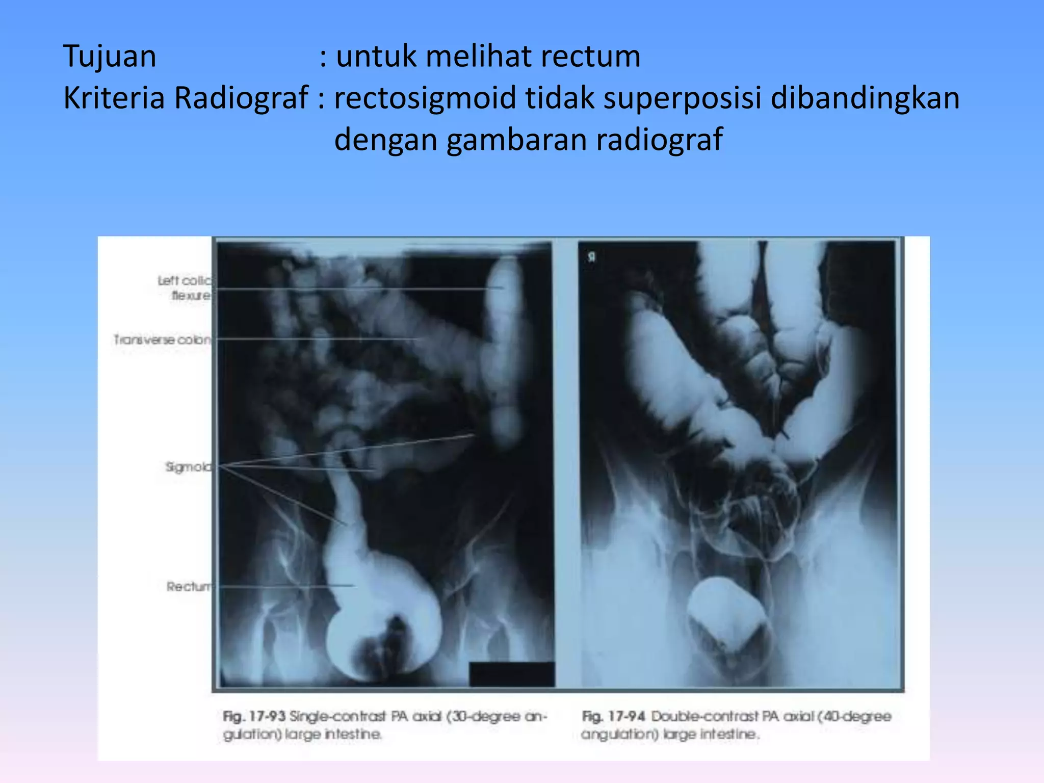 Teknik Pemeriksaan Radiografi Colon In Loop (CIL) | PPTX