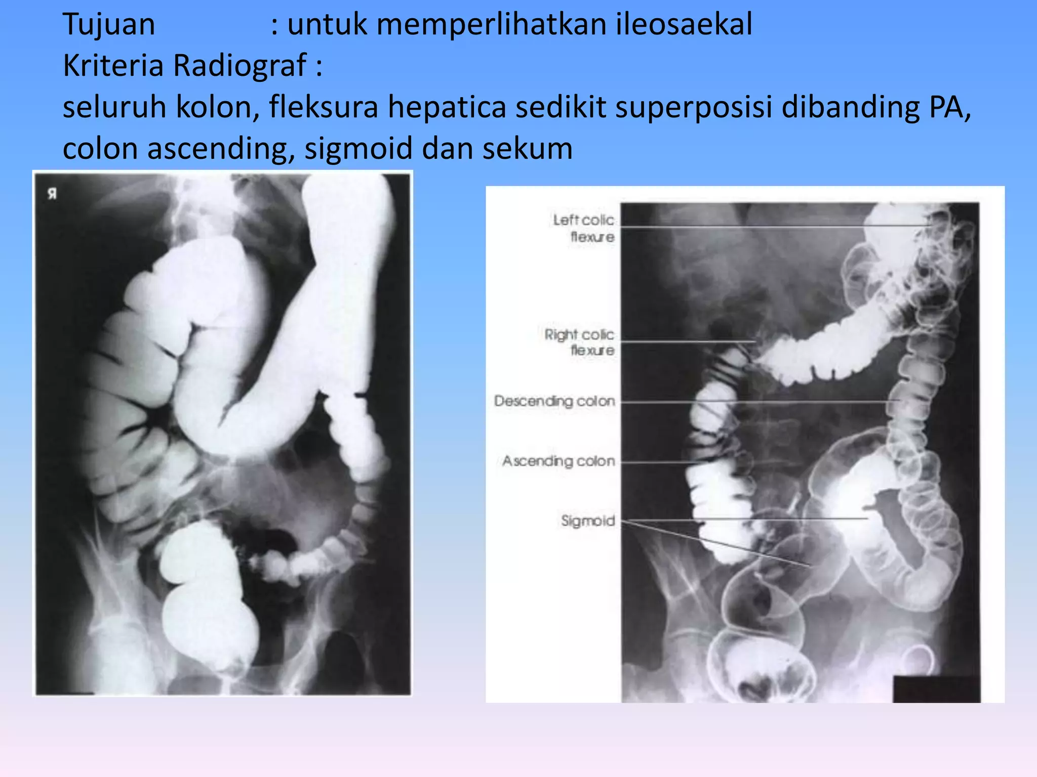 Teknik Pemeriksaan Radiografi Colon In Loop (CIL) | PPTX