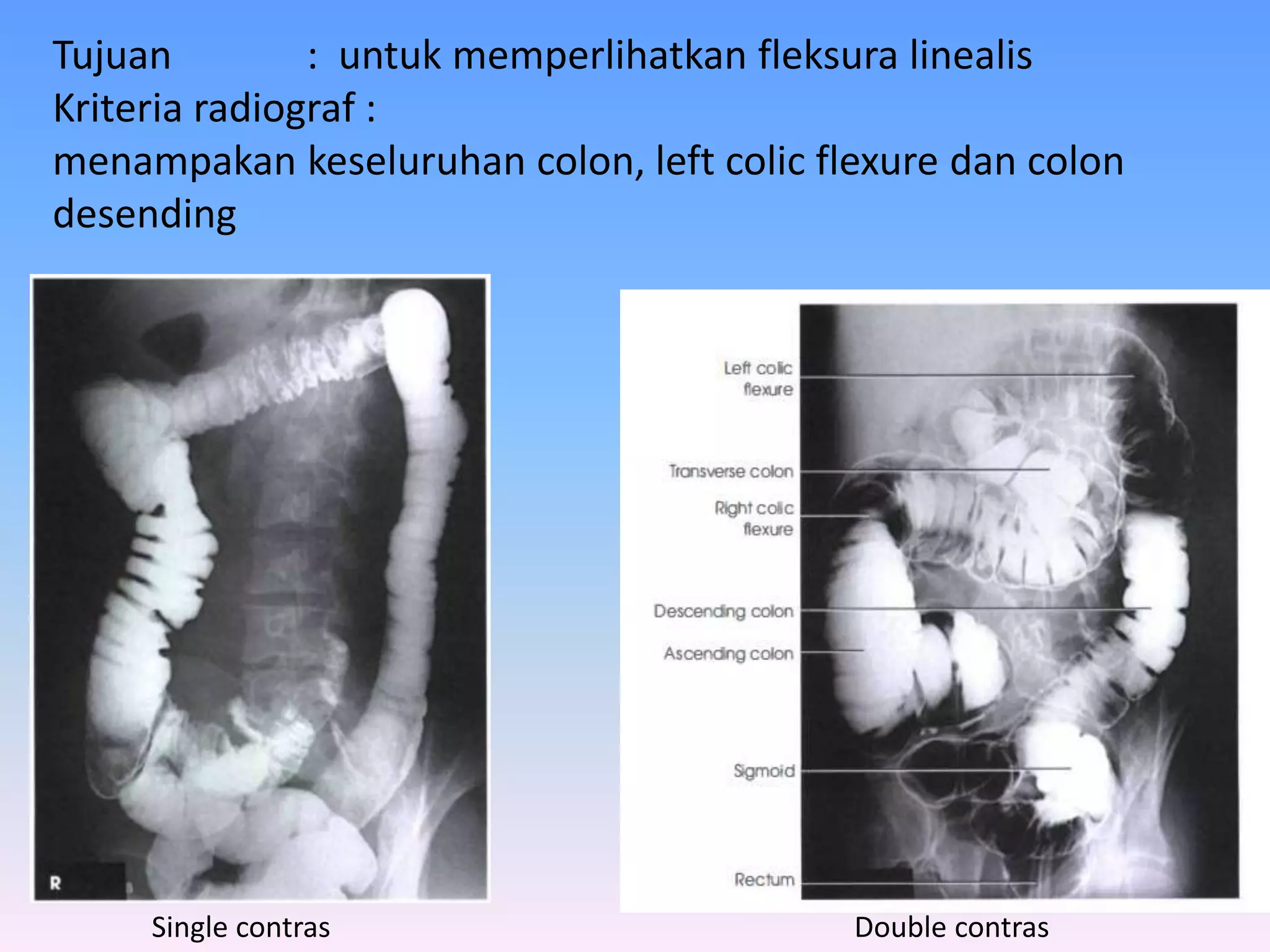Teknik Pemeriksaan Radiografi Colon In Loop (CIL) | PPTX