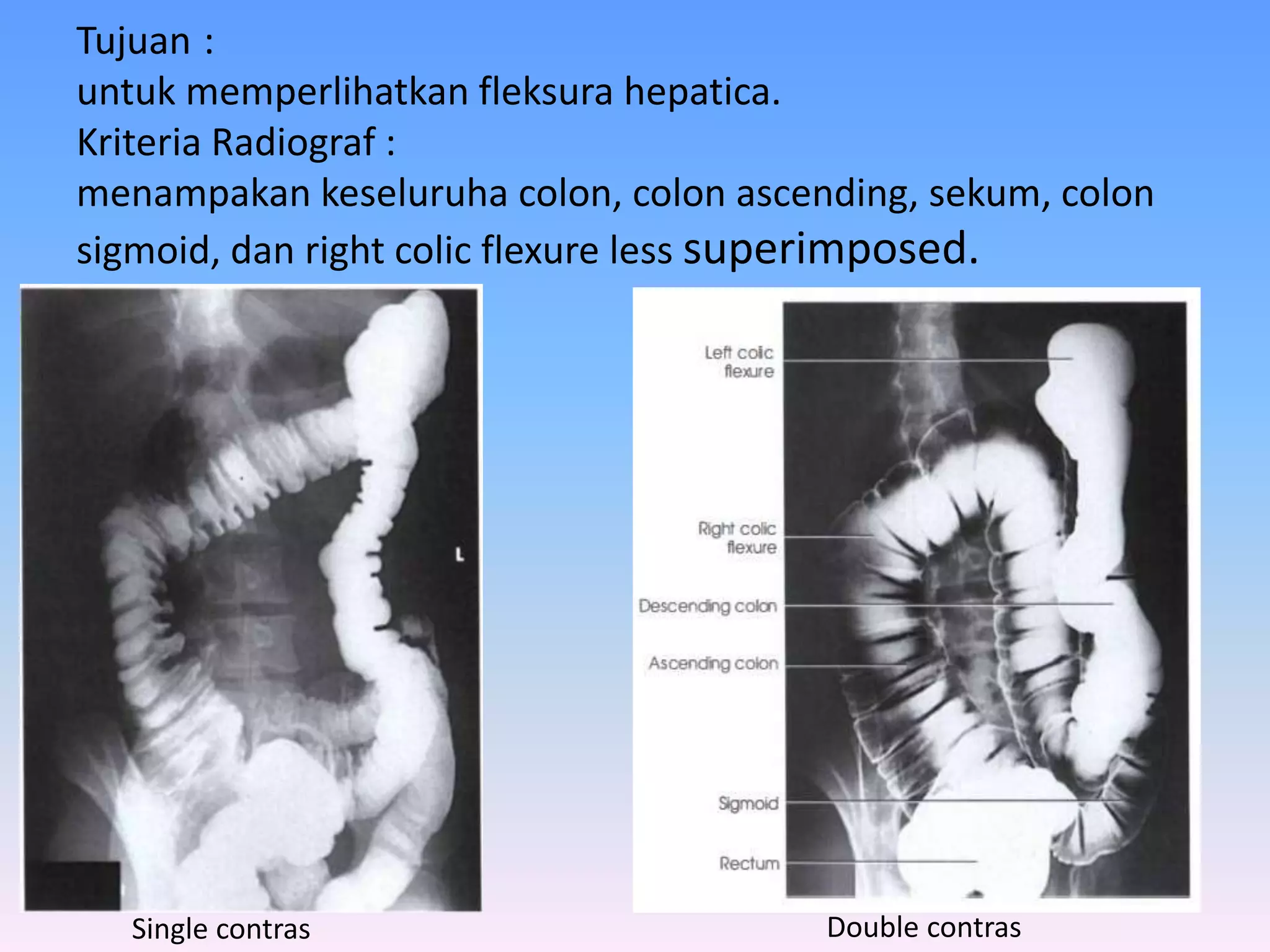 Teknik Pemeriksaan Radiografi Colon In Loop (CIL) | PPTX