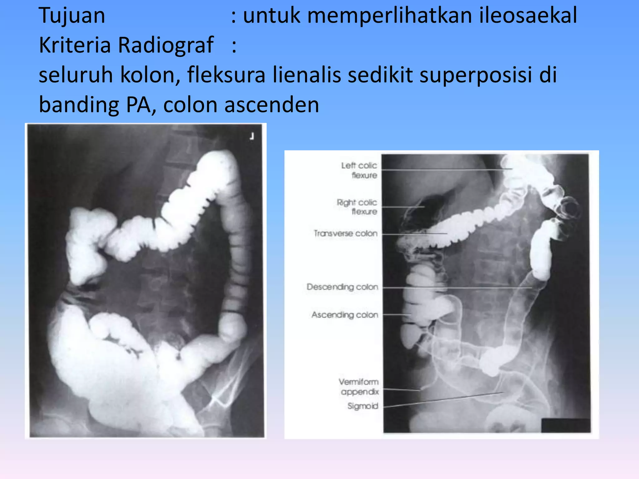 Teknik Pemeriksaan Radiografi Colon In Loop (CIL) | PPTX