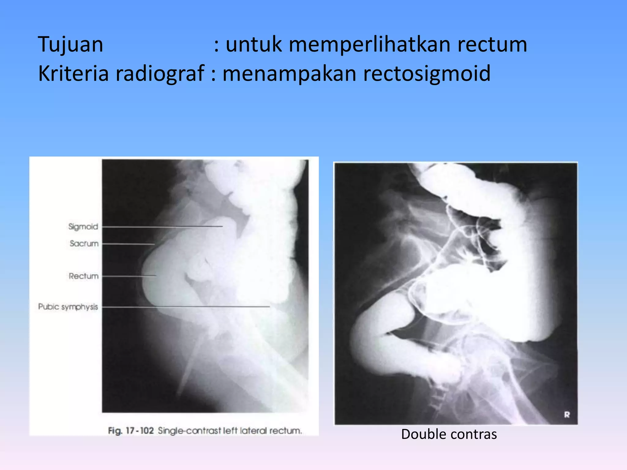 Teknik Pemeriksaan Radiografi Colon In Loop (CIL) | PPTX
