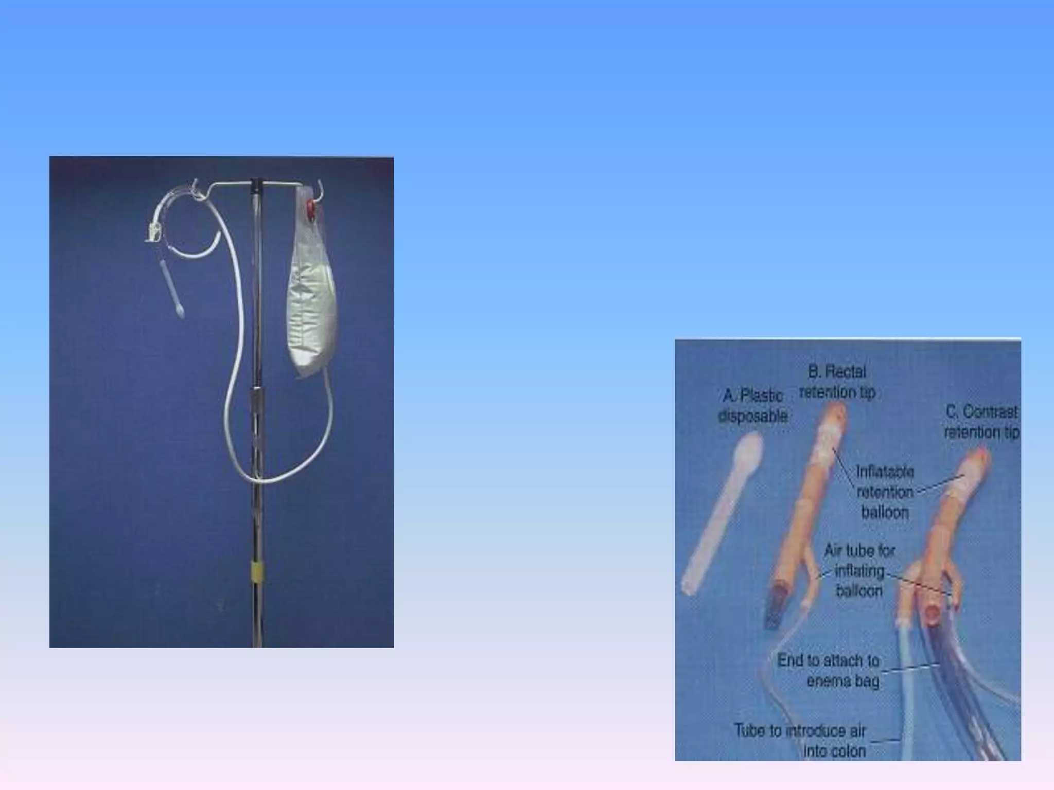 Teknik Pemeriksaan Radiografi Colon In Loop (CIL) | PPTX