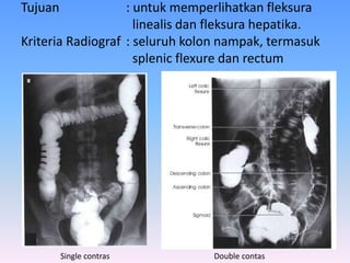 Teknik Pemeriksaan Radiografi Colon In Loop (CIL) | PPTX