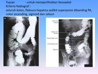 Teknik Pemeriksaan Radiografi Colon In Loop (CIL) | PPTX