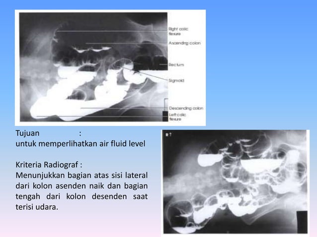Teknik Pemeriksaan Radiografi Colon In Loop (CIL) | PPTX