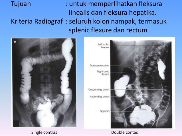 Teknik Pemeriksaan Radiografi Colon In Loop (CIL)