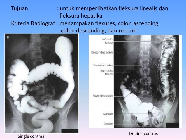 Teknik Pemeriksaan Radiografi Colon In Loop (CIL)